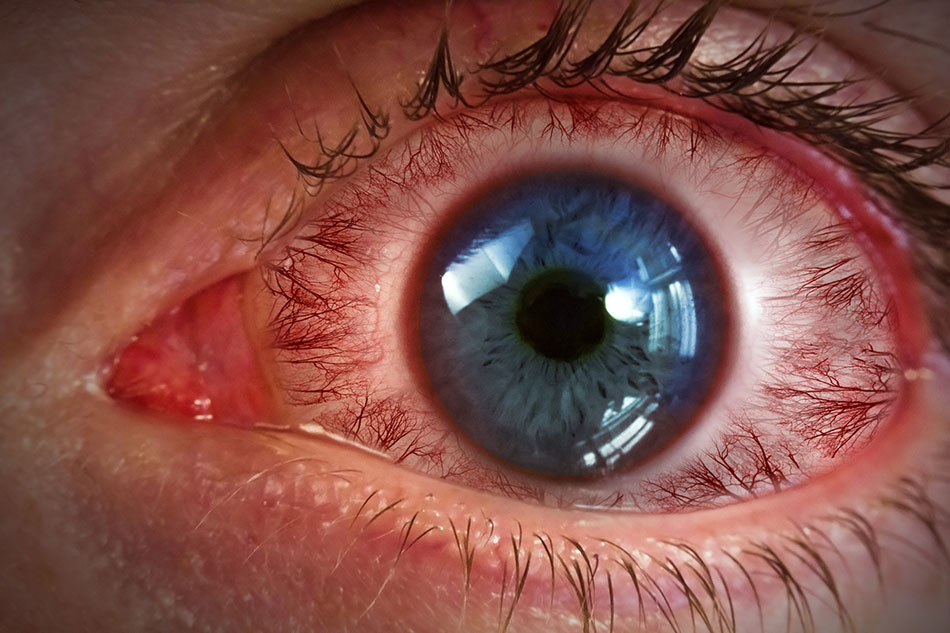Smoking And Contact Lenses Why Do Your Eyes Get Red When You Smoke Smoking And Contact Lenses Why Do Your Eyes Get Red When You Smoke