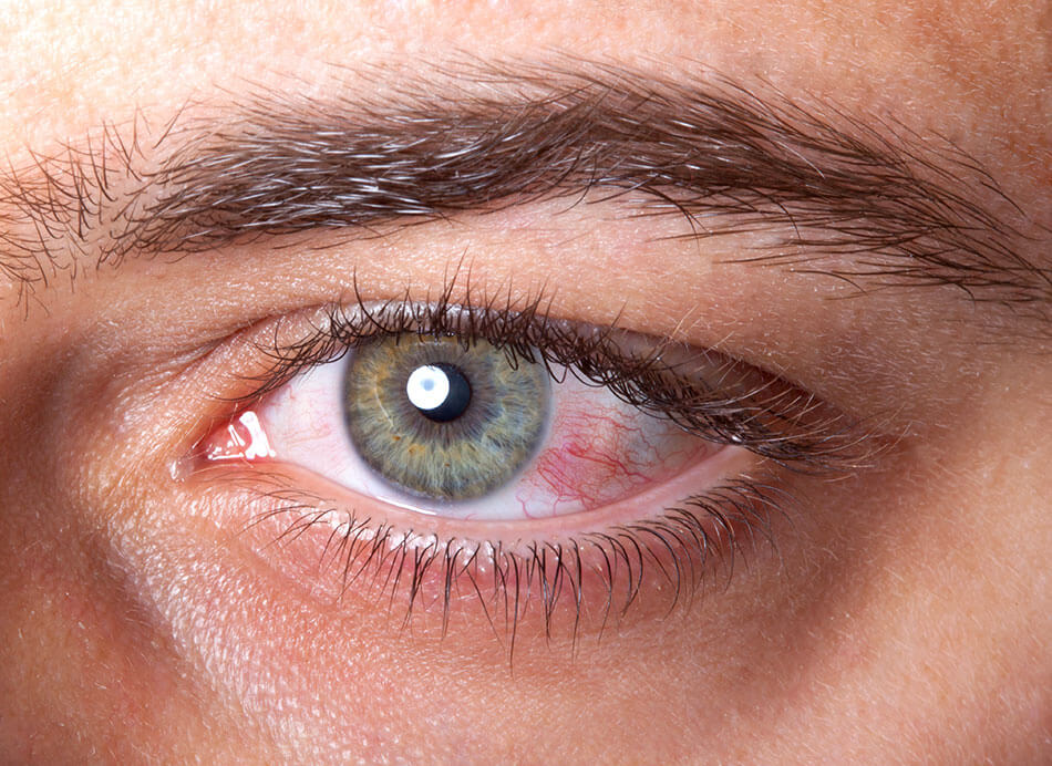 Why Are My Contacts Blurry How To Fix 5 Common Contact Lens Problems